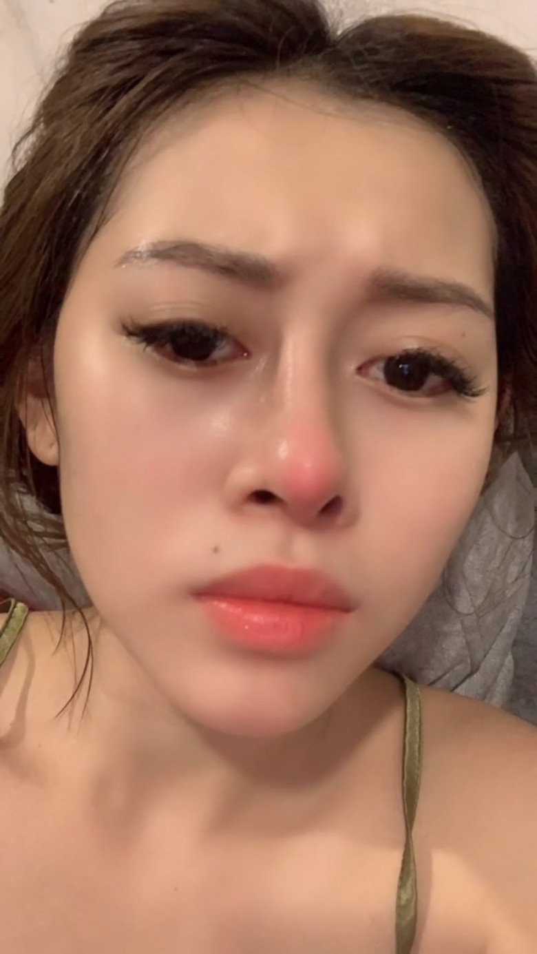 Hãi hùng ảnh người nổi tiếng triệu view nâng mũi lòi sụn trắng, chị em nghe xong hết muốn sửa sang