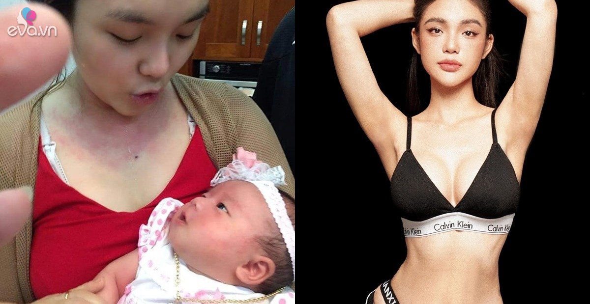 Yeye Nhật Hạ sau sinh chằng chịt vết rạn, dị ứng khắp người, nỗ lực giảm 38kg lấy lại vóc dáng ...