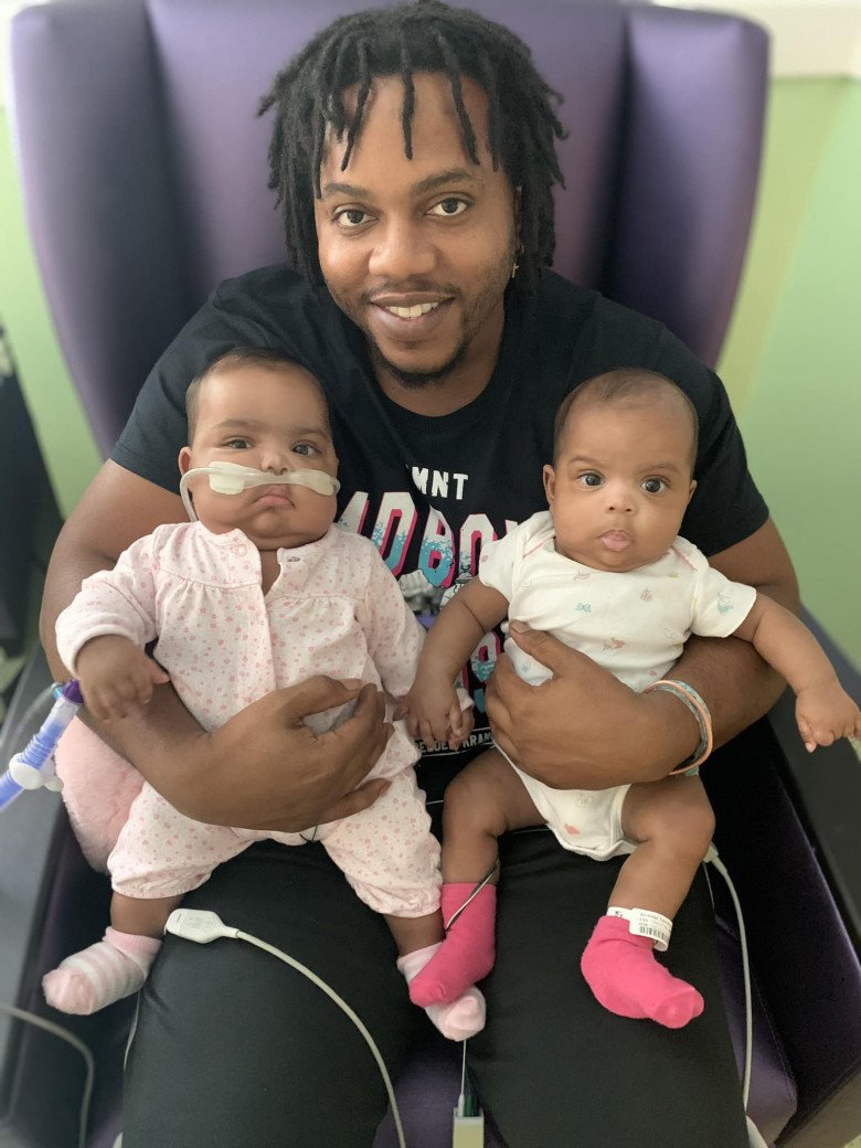 Cực hiếm: Cặp song sinh dính liền có chung lá gan, sau sinh trải qua ca ...