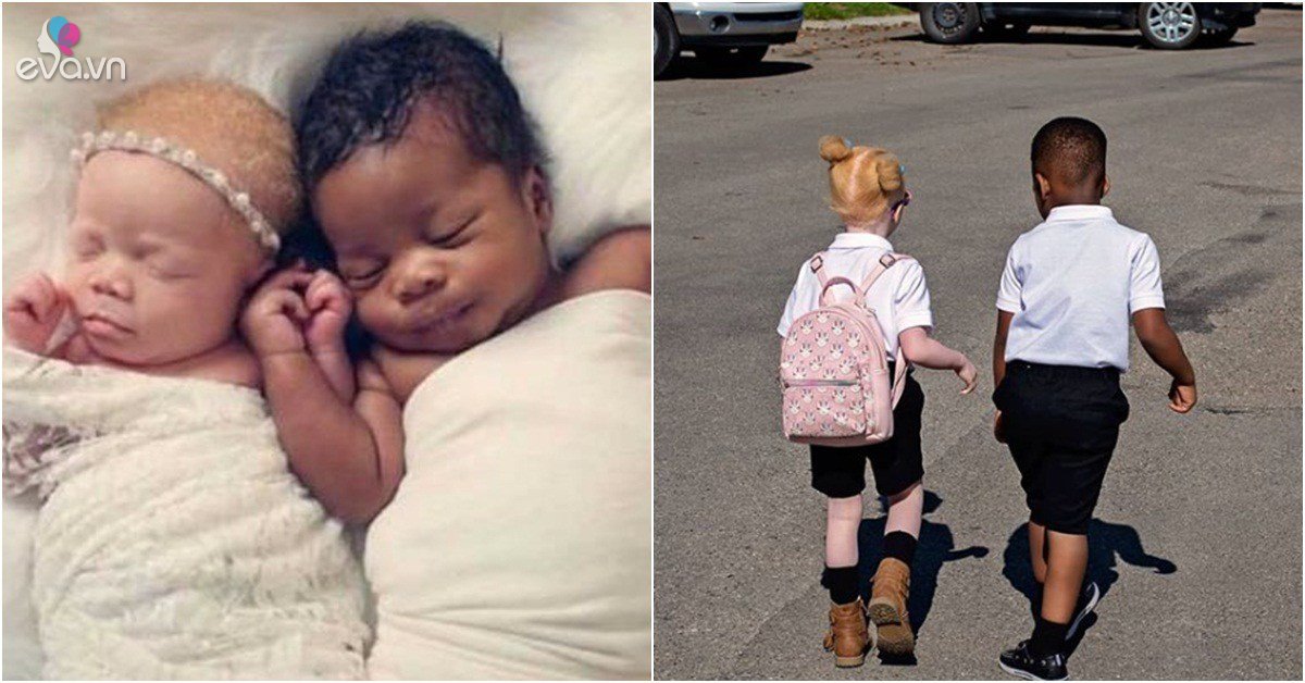 Cuộc sống sau 4 năm của cặp song sinh 1 đen, 1 trắng do bị đột biến gen