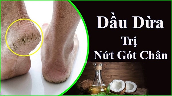10 Cách trị nứt gót chân tại nhà tự nhiên an toàn hiệu quả nhanh nhất