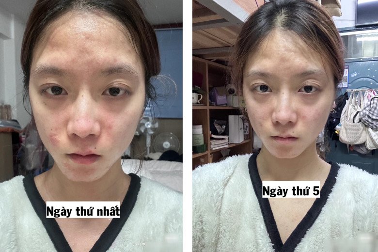 Dưỡng da kiểu sinh viên 0 đồng, cô gái mặt mụn chi chít như thay da sau ...