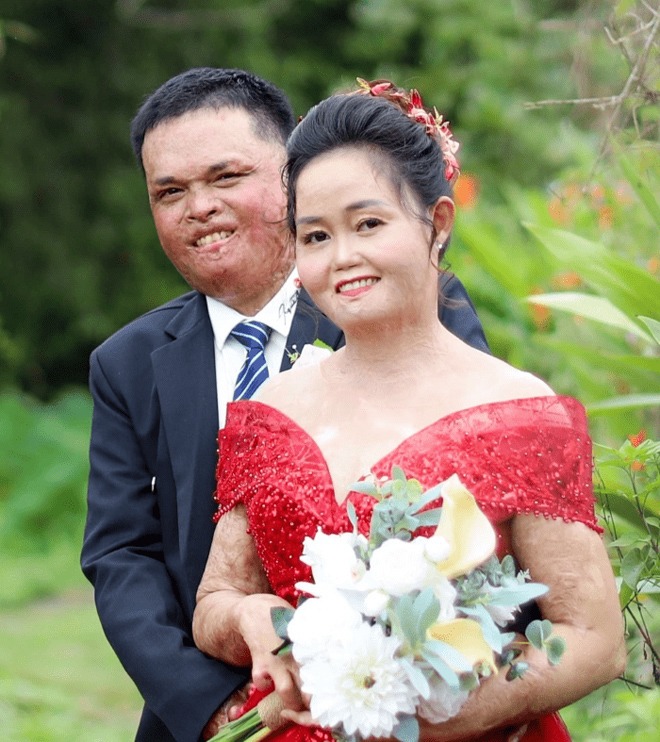 Người phụ nữ bị chồng cũ thiêu sống bất ngờ làm đám cưới, danh tính chú rể khiến tất cả xúc động